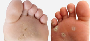 Verrucae & Wart Treatment | Sussex Foot Centre