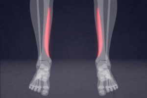 Shin Splints Assessment & Treatment | Sussex Foot Centre